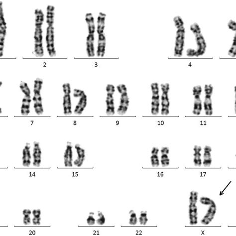 Pdf Identification Of An Sry Negative 46xx Infertility Male With A