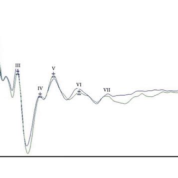 Series of auditory brainstem response (ABR). Seven waves of I, II, III ...