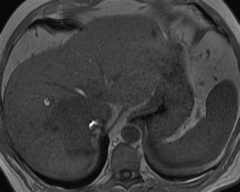 Liver Atlas Case 362 Cholangiocarcinoma