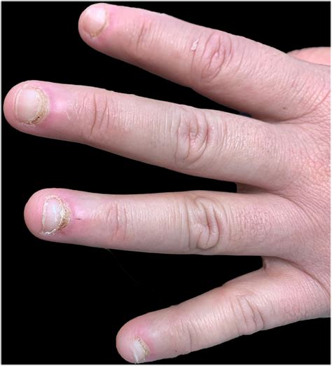 Systemic Sclerosis Journal Of The American Academy Of Dermatology