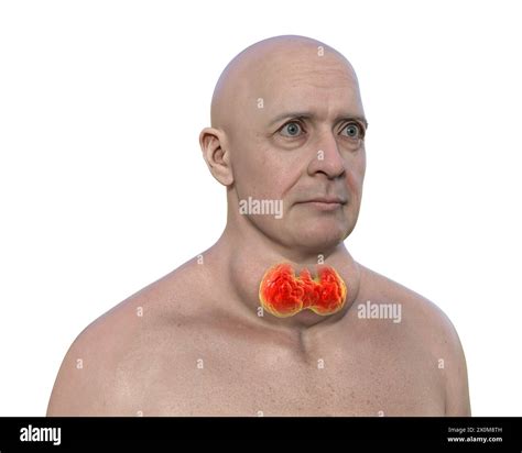 3d Illustration Of A Man With An Enlarged Thyroid Gland Goitre Base Of Neck And Abnormal