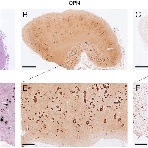 topographical co‐localization of opn and psmad2 3 staining in calcified