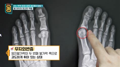 족저근막염 주사 없이 고치는 방법 발통증 줄이는 비법 공개 귀하신 몸