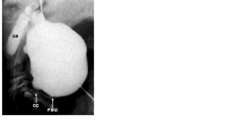 Intraoperative Cholangiogram Showing Cystic Dilatation Of The Common