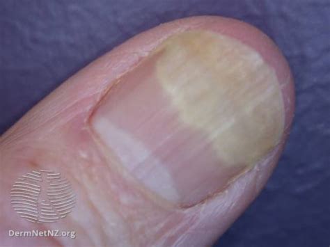 Onycholysis Causes And Treatment