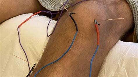 El Dolor De Rodilla Y Su Tratamiento Con Acupuntura