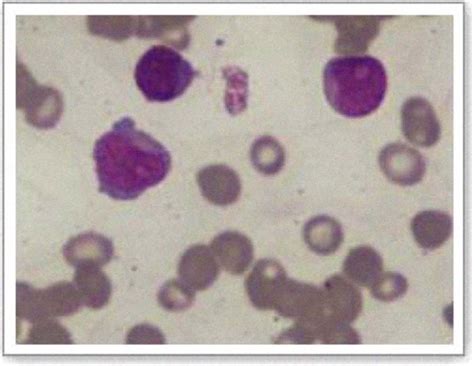 Original Acute Leukemia Image Figure 3a Shows The Results Of The S