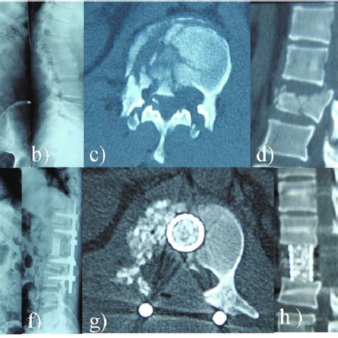 Pdf One Stage Partial Vertebrectomy Titanium Mesh Implantation And