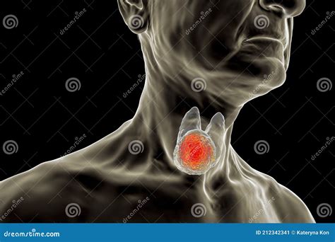 Thyroid Cancer Illustration Stock Illustration Illustration Of