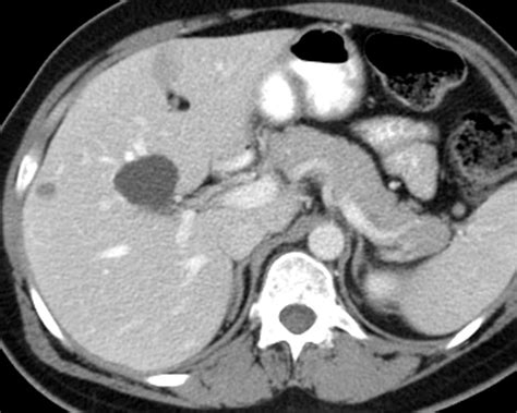 Liver Atlas Diagnosis Choledochal Cyst