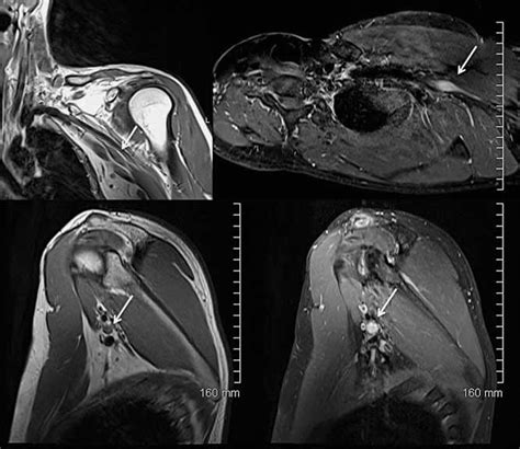 Mri Of Left Brachial Plexus Using The Modified Technique In 2011 As A Download Scientific