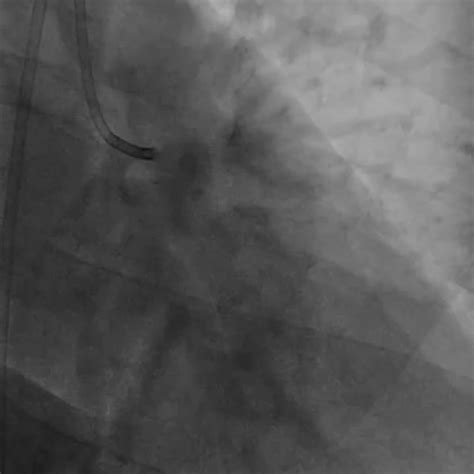 Dual Cto And Lad D Bifurcation Aly Tohamy