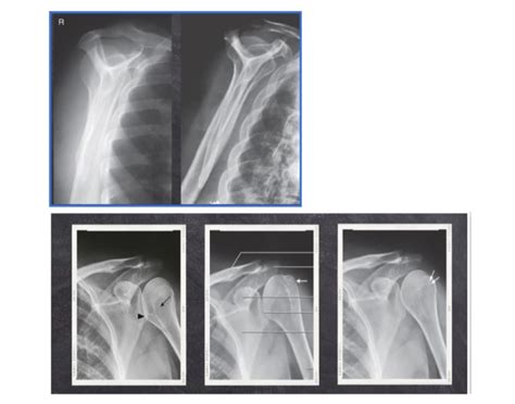 Int Vs Ext Vs Neutral Rotation Neer Vs Scap Y Quiz