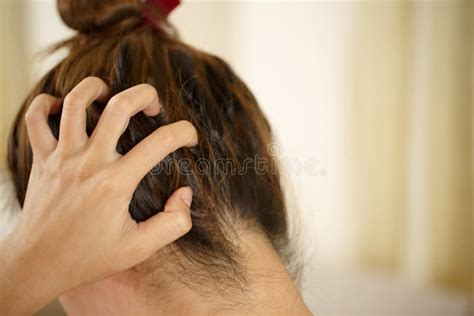 A Woman Has Problems With Hair And Scalp Stock Photo Image Of Head Adult