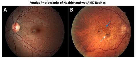 Macular Atrophy Skin