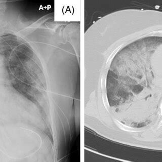 A Chest Radiographs On Admission Showing Diffuse Infiltration In Download Scientific Diagram