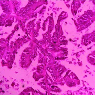 Photomicrograph Showing Papillary Renal Cell Carcinoma Left Kidney Download Scientific Diagram