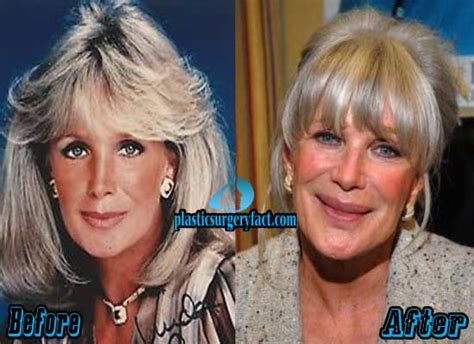 Linda Evans Facelift Before And After