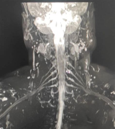 Mri Brachial Plexus Sequence T2 Space Cor Magnetom Vida Deep Resolve 3t Farid