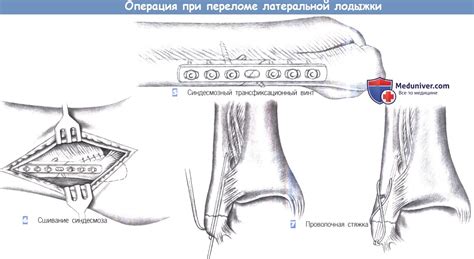 Этапы и техника операции при переломе латеральной лодыжки