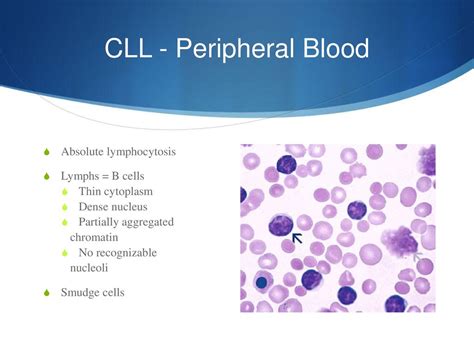 Acute And Chroinc Leukemia Ppt Download