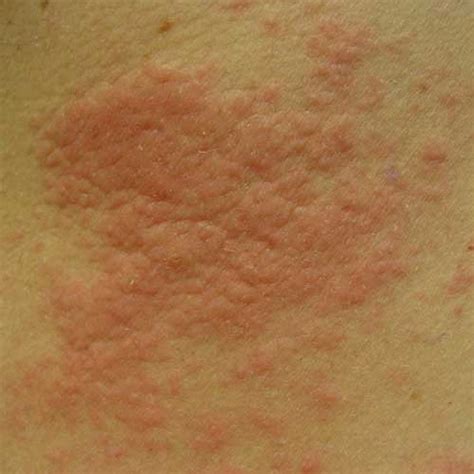 Allergic Reaction Symptoms Of Hives