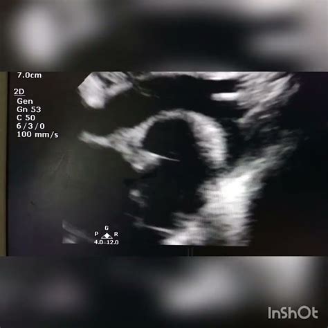 Term Neonate With Coa And Pda Youtube