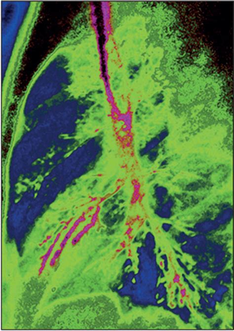 Bronchiectasis A Global Disease Necessitating Global Solutions The