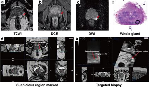 Steps For Mpmri And Trus Fusion Guided Targeted Prostate Biopsy And Download Scientific Diagram