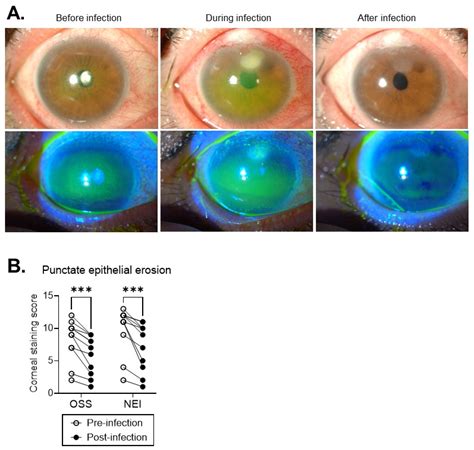 Punctate Epithelial Erosions