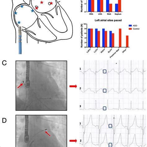 Right And Left Atrial Voltage Map Highlighting The Position Of The