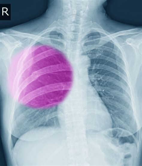 Understanding Rib Fractures Causes Types Symptoms And Management