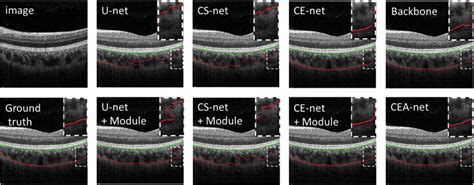 compare results of other methods in choroid boundary detection on