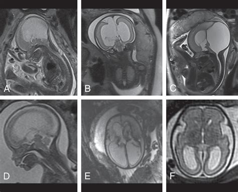 Hydrocephalus And Other Cerebrospinal Fluid Disorders Clinical Tree