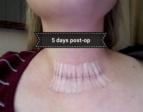 Pin On Thyroidectomy