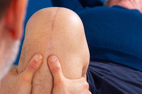 What Is Knee Synovitis And How Is It Treated Emergency Live