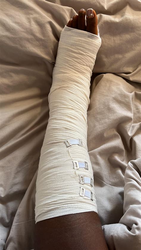 Trimalleolar Fracture Rbrokenankles