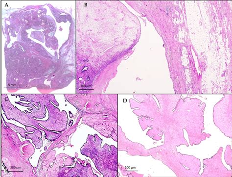 Borderline Pt Appearing As A Lobulated Mass With Focally Permeating