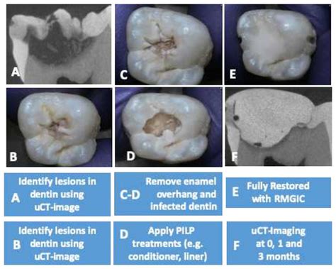 Natural Carious Lesions Minimally Invasive Preparation And Restoration Download Scientific