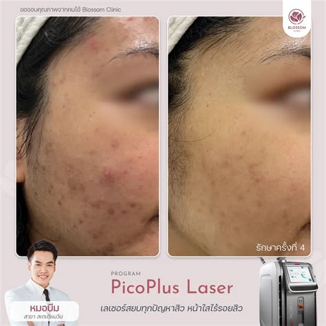 Pico Laser คืออะไร ทำไมถึงยอดนิยม ลดกระ ฝ้า ที่ Blossomclinic