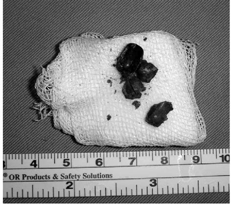 Photograph Of The Foreign Body After Removal Download Scientific Diagram