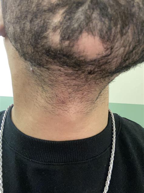 Beard Alopecia Help Rbeards