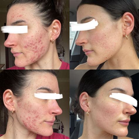Bilder Von Accutane Results Accutane Before And After Reviews Afoj