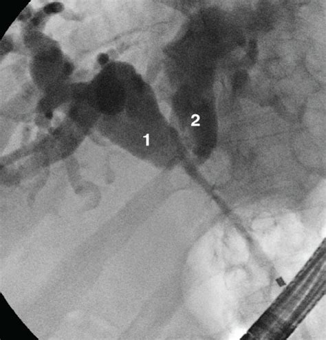 Bismuth Type Ii Hilar Stricture The Main Hepatic Confluence Is Download Scientific Diagram