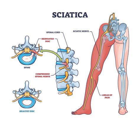 Sciatica Lumbar Radiculopathy Pain Institute Of Southern Arizona