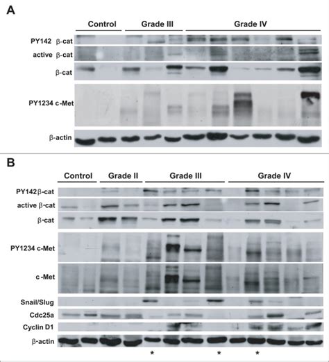 Nuclear Phosphorylated Y142 β Catenin Accumulates In Astrocytomas And