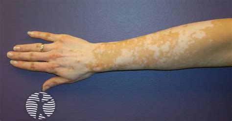 Vitiligo Image