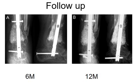 Masquelet 技术:骨缺损修复新选择! 德医医学 助力医学教育发展! Masquelet 技术:骨缺损修复新选择! 德医医学 助力医学教育发展!