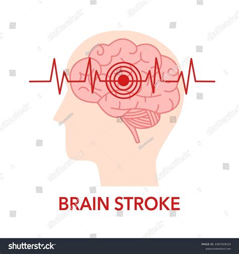 Human Brain Stroke Problem Flat Design Stock Vector Royalty Free