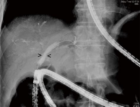 Radiologic View Of A Balloon Dilation Of A Stenotic Hepaticoje­ Download Scientific Diagram